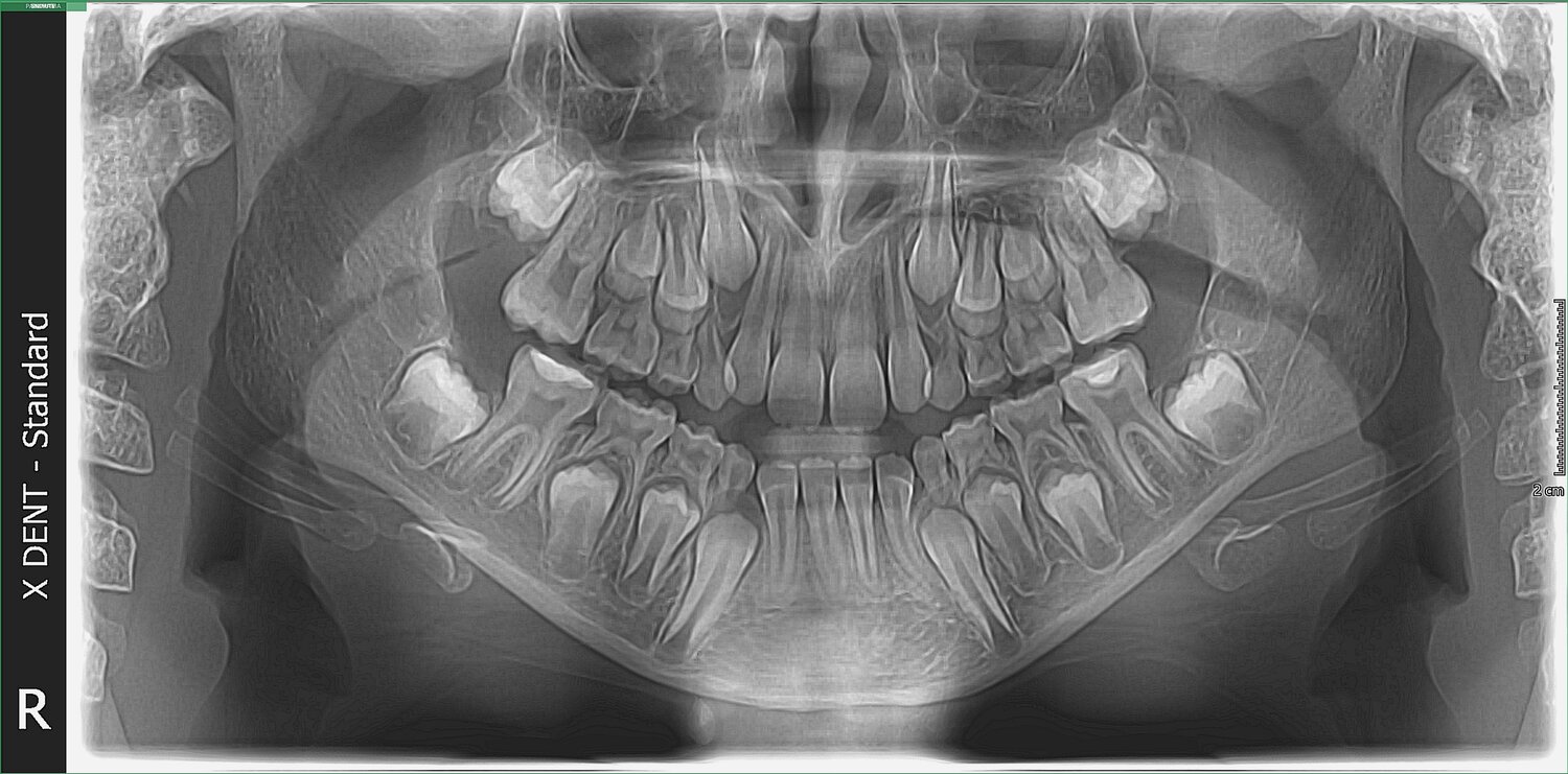 Dečiji ortopantomogram Beograd