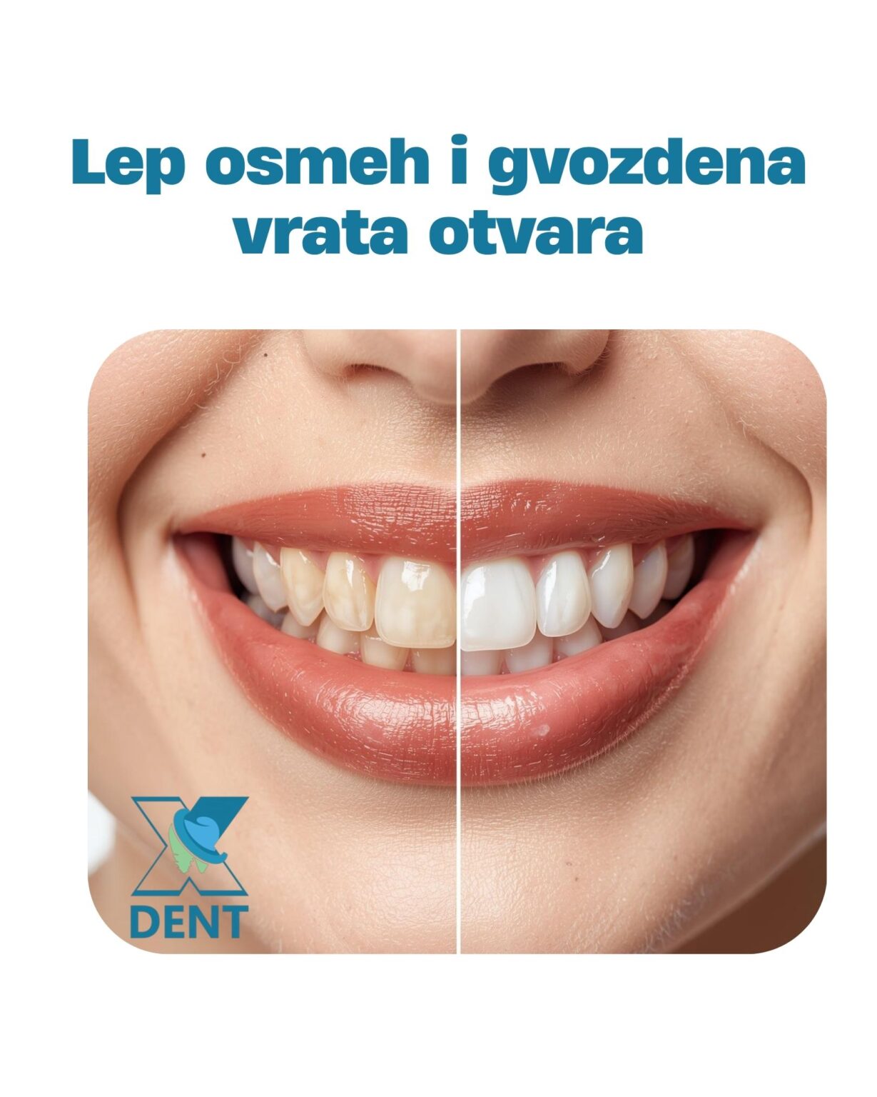 Žuti zubi – uzroci, rešenja i put ka beljem osmehu Žuti zubi – uzroci i ...